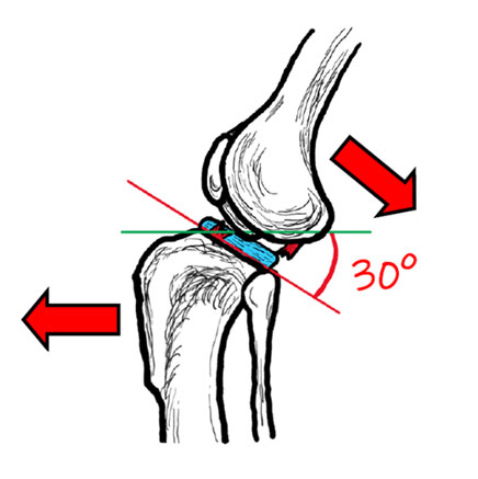 Extracapsular Lateral Suture Stabilisation (ELSS) - Canine Cruciate ...